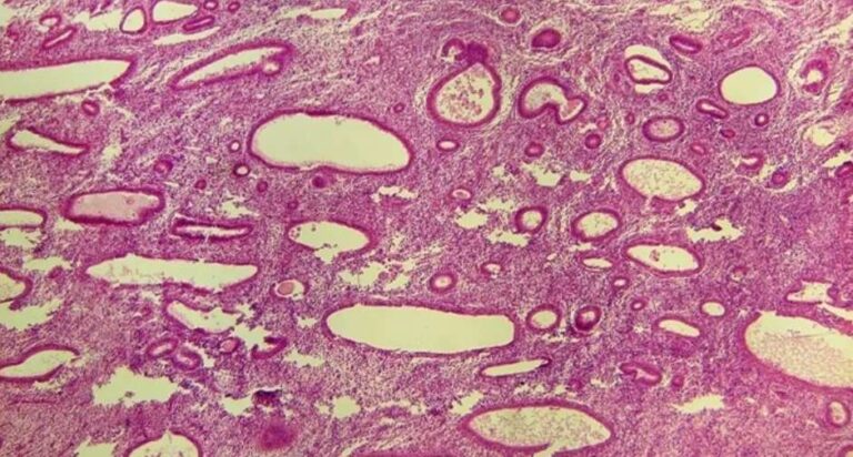 Hiperplasia prostática benigna: do que preciso saber?